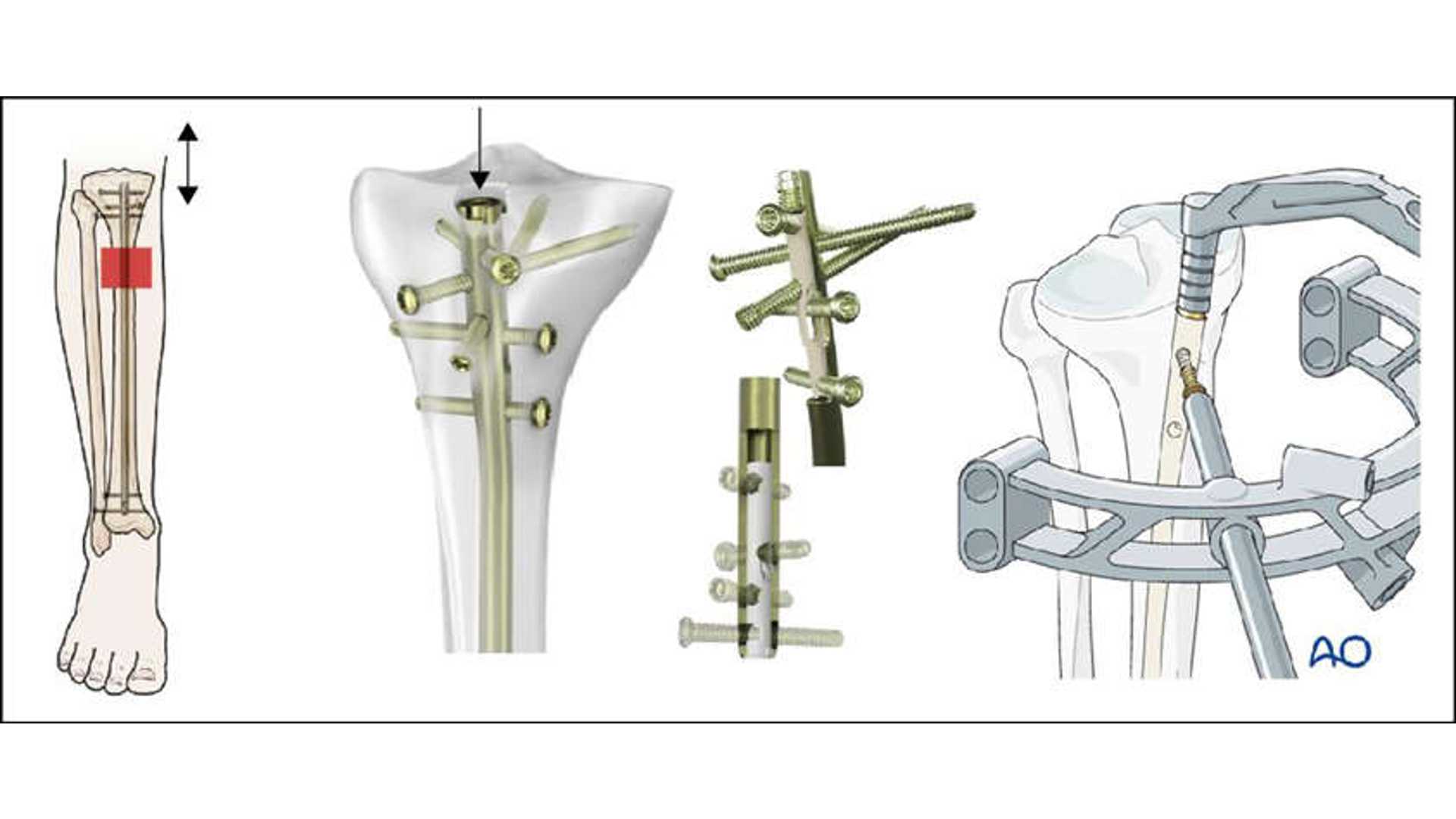 First in India: MIOT launches Tibia Nail Advanced System to treat fractures