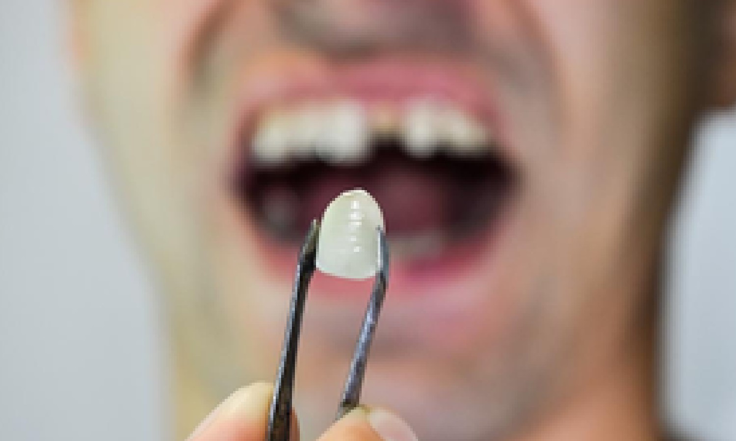 New technique to replace lost teeth: Experts